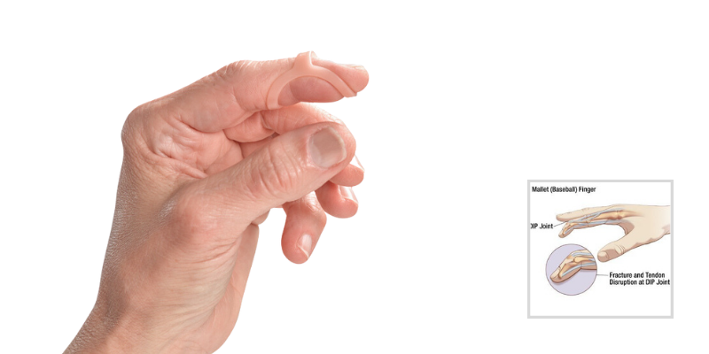 Treatment For Mallet Finger